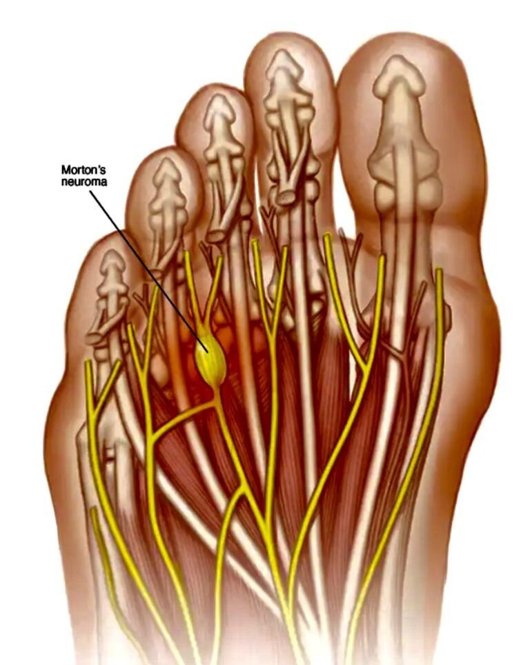 Neuromas - Podiatry Associates