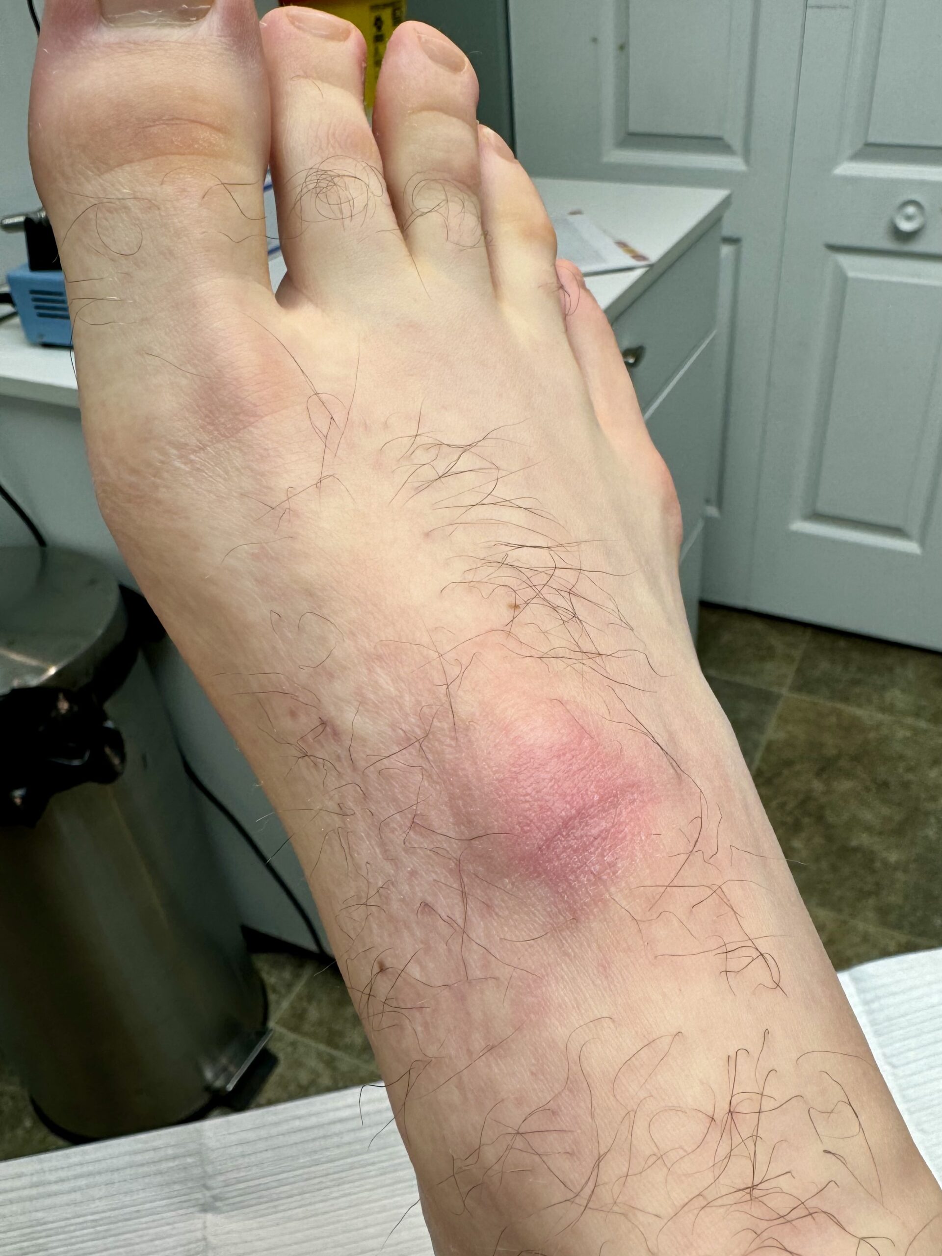 What causes the hard painful bump on top of the foot